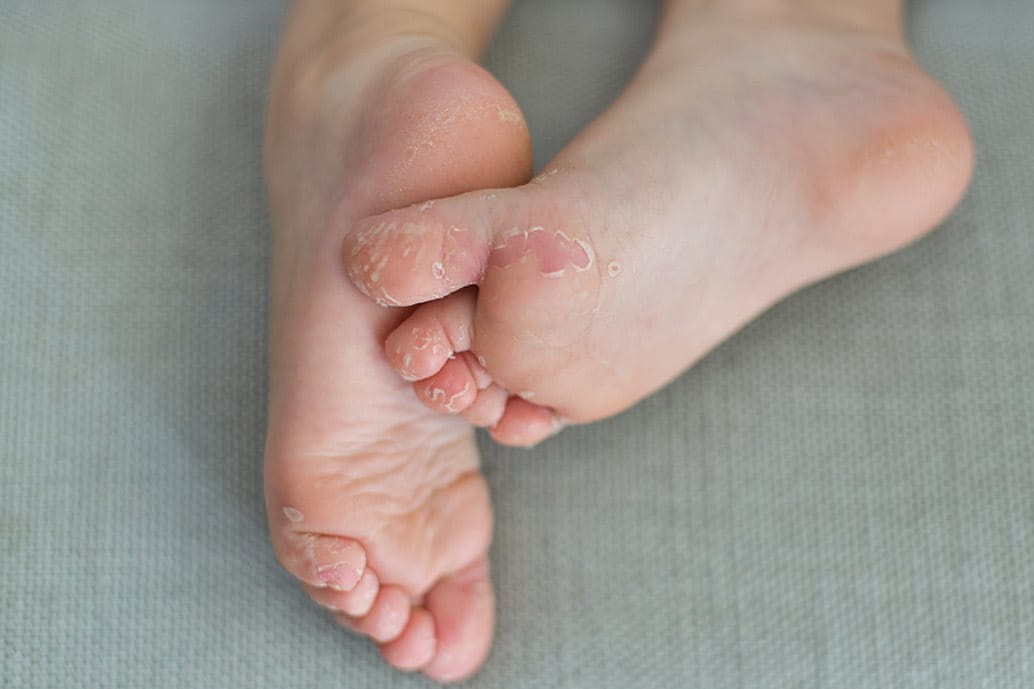 Prurito ai piedi: cause e i rimedi | Eucerin Prurito ai piedi: cause e i rimedi | Eucerin